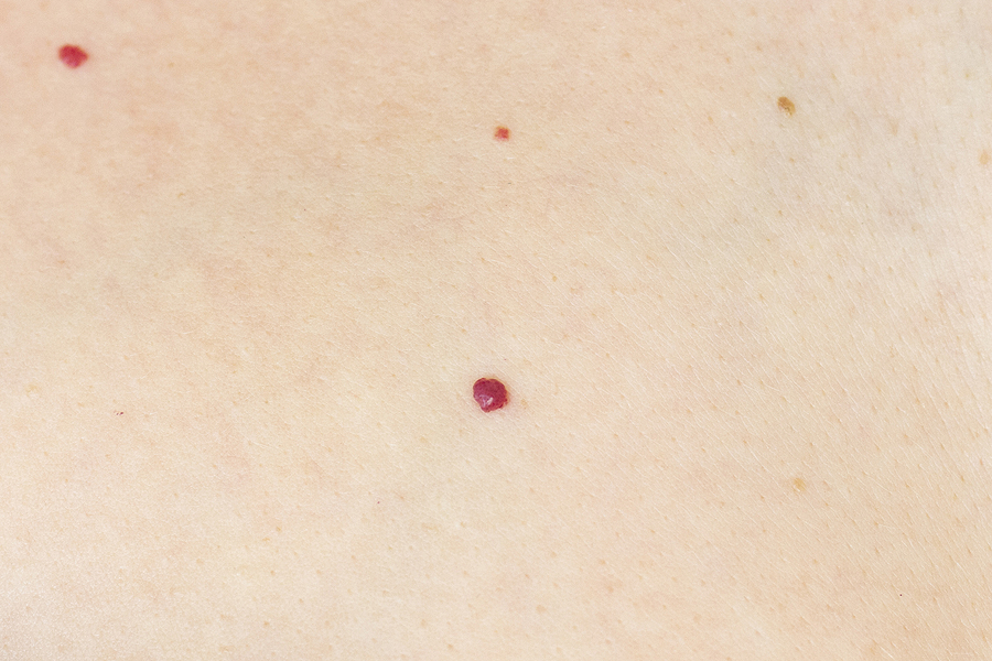 Red Spots Treatment - Design Dermatology and Aesthetics