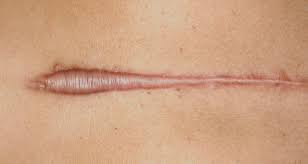 Keloid scars - Design Dermatology and Aesthetics